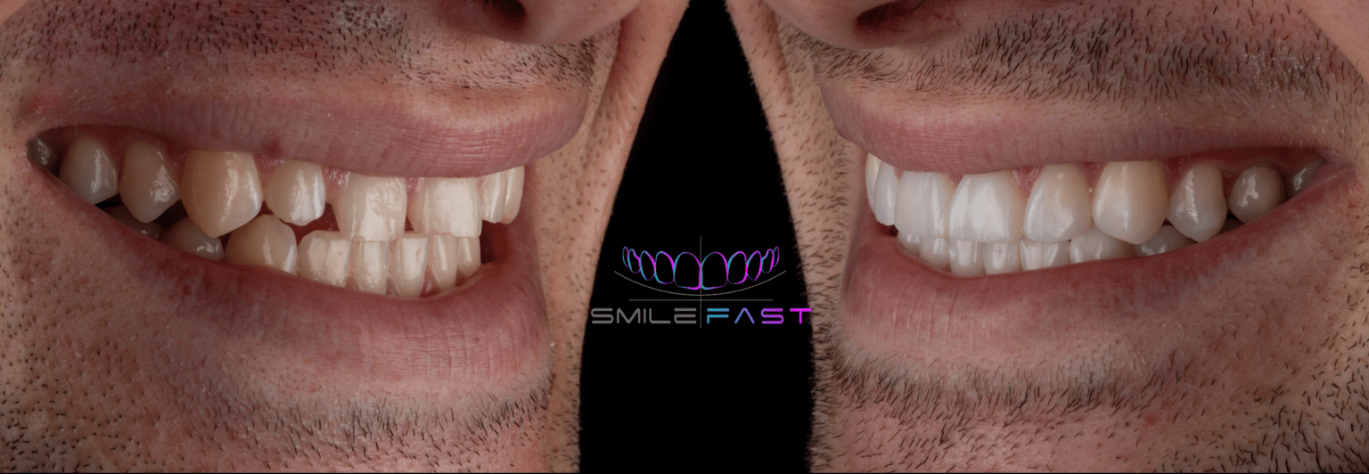 SmileFast | Birchgrove Dental Cardiff