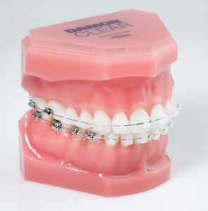 Damon Clear Braces | Birchgrove Dental