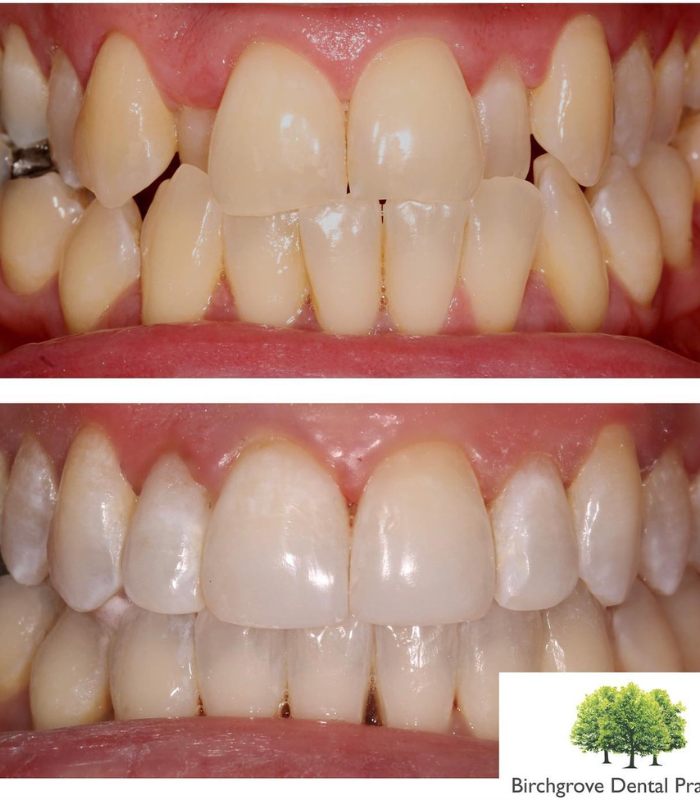 Damon Braces Cardiff | Birchgrove Dental