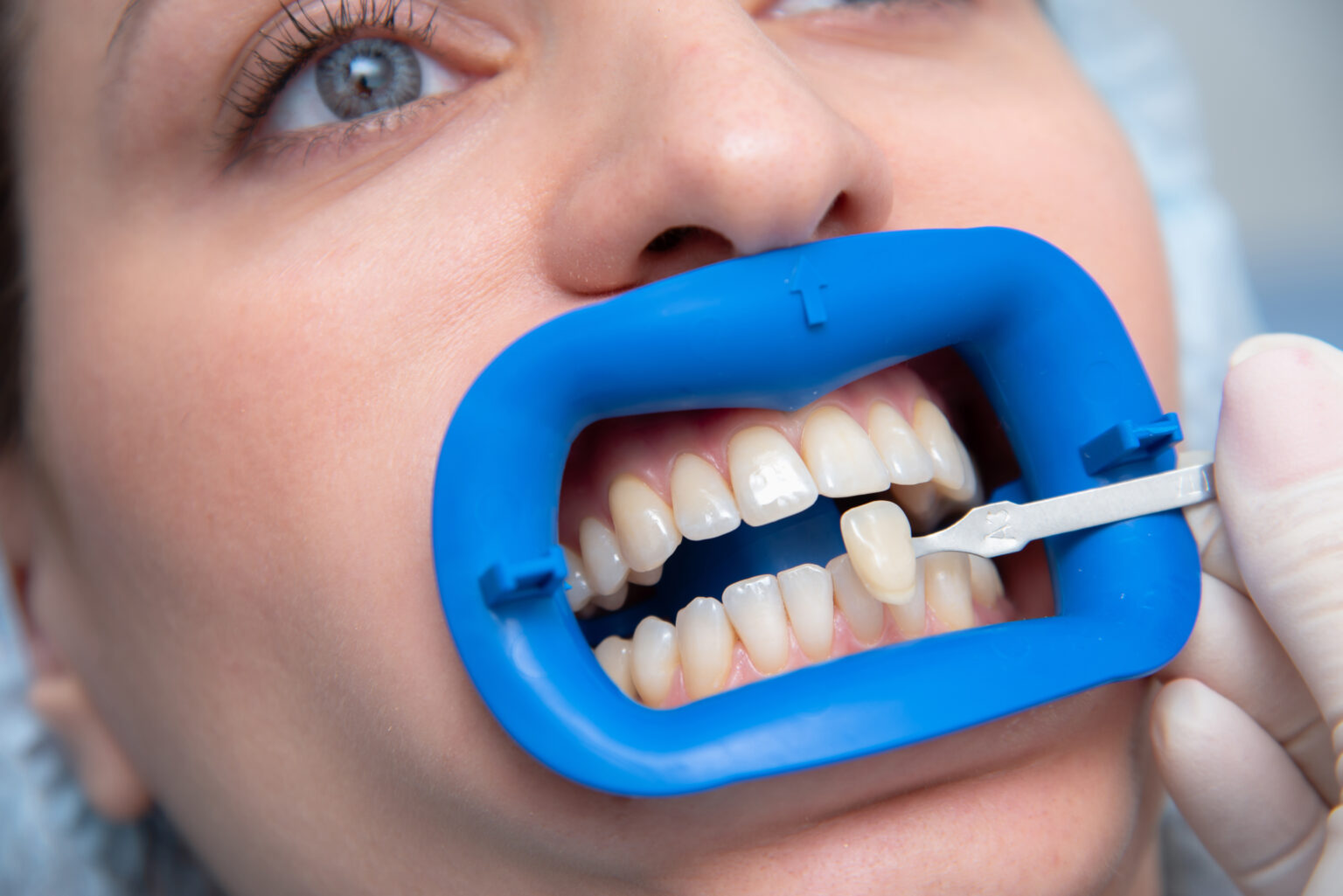 How Much is Composite Bonding Per Tooth in the UK?